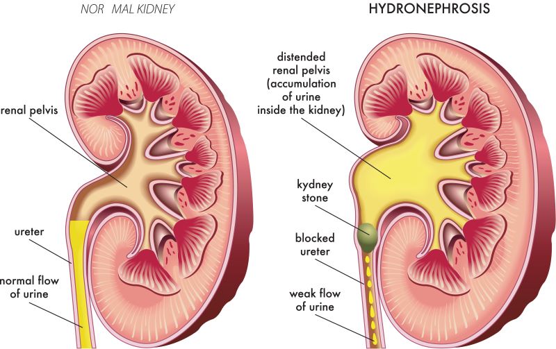 Hydronephrosis Care & Treatment | Urologic Surgery of NWI