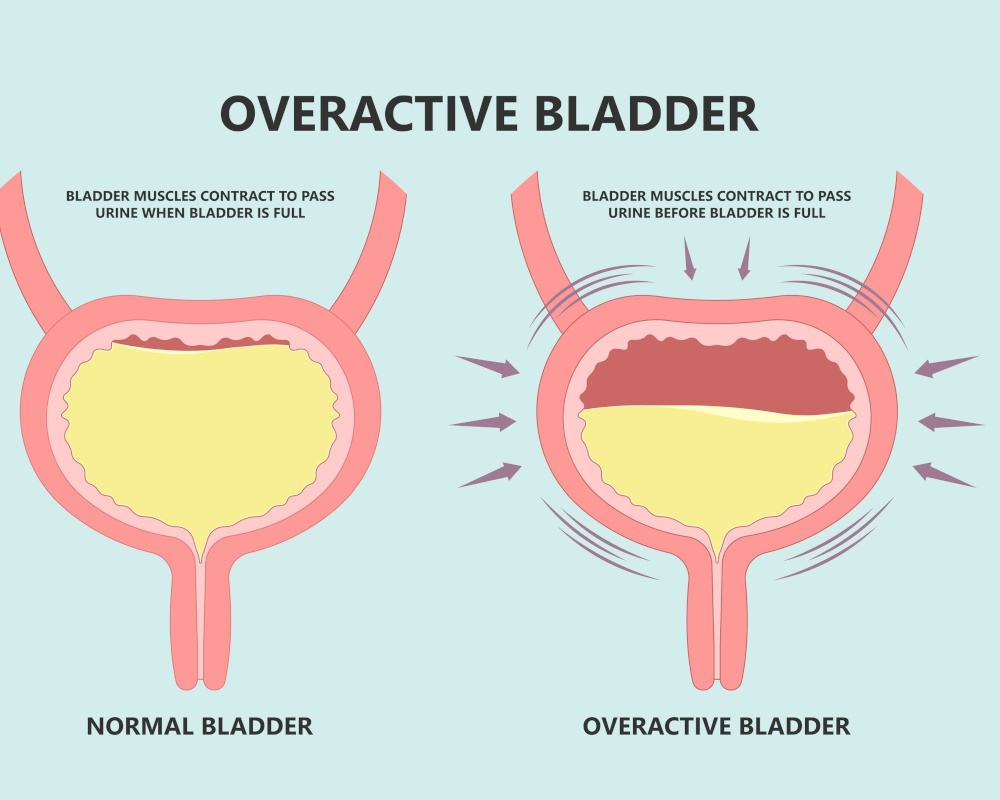 Irritable Bladder